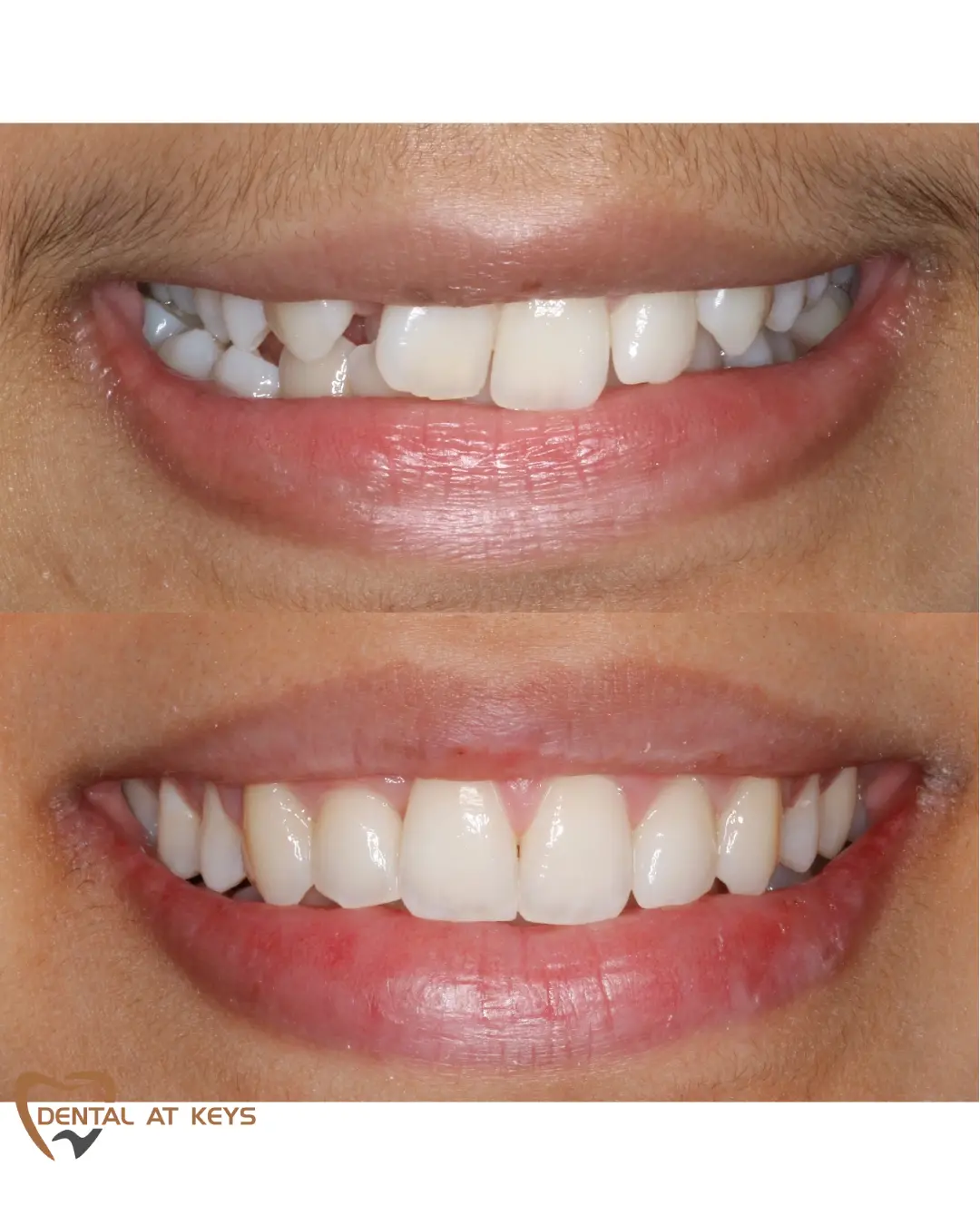 The Smile of your Dreams! 🥰 - Dental at Keys