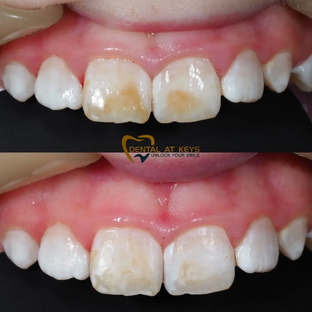 Say Goodbye to stubborn stains! (Enamel Microabrasion) 🦷 - Dental at Keys